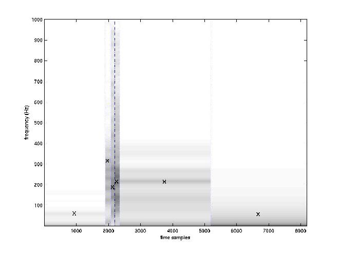 KNEE JOINT VIBRATION SIGNAL ANALYSIS FOR SCREENING OF ARTRICULAR ...